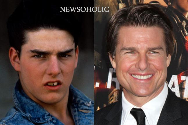 Celebrity teeth: before and after smile makeovers - newsoholic